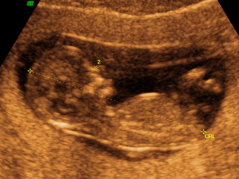 12. Schwangerschaftswoche (12. SSW): Alle Infos | Eltern.de