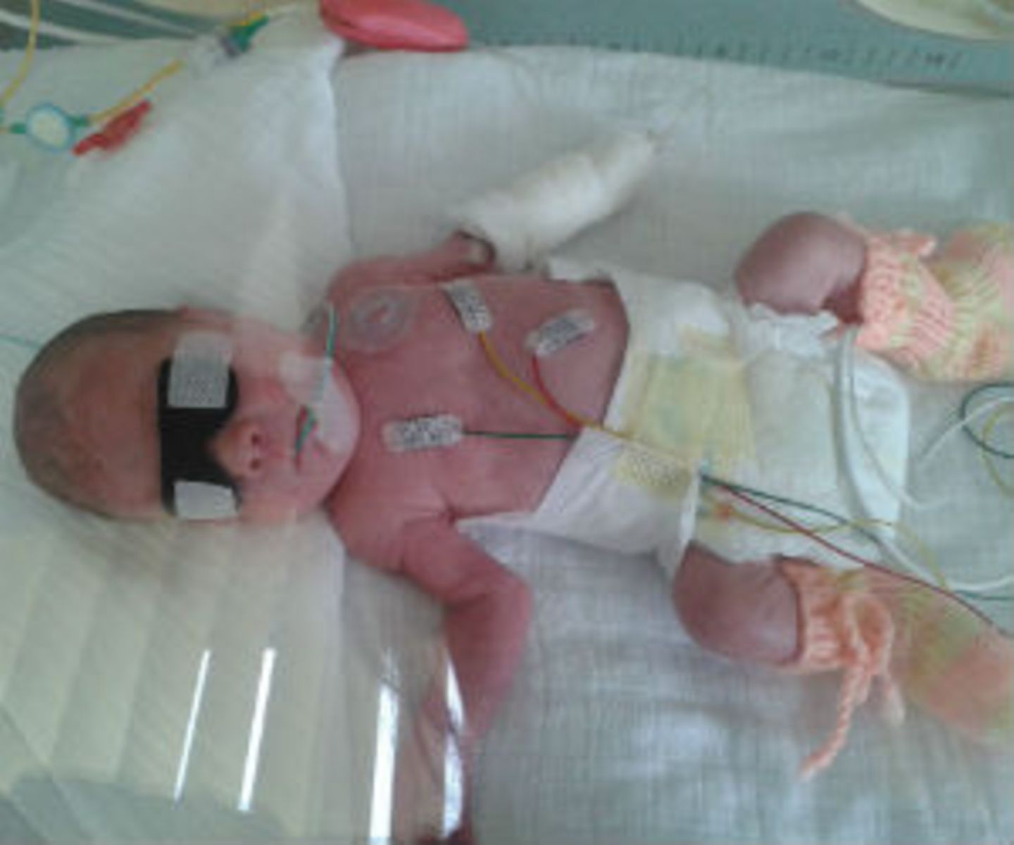 Matilda geboren in der 24 ssw mit 33 cm und 660g | Eltern.de