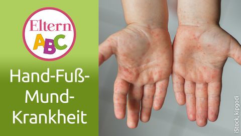Eltern ABC: Hand-Fuß-Mund-Krankheit | Eltern.de