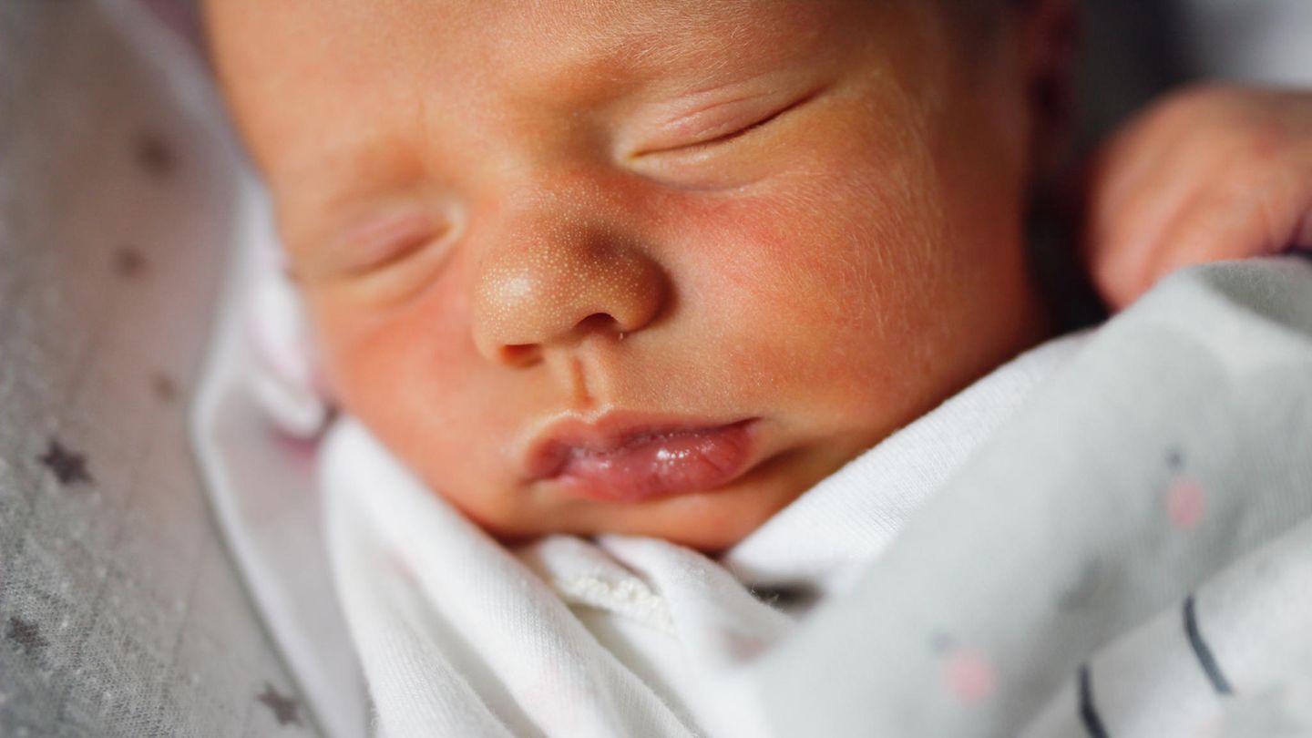 Milien bei Babys: Was tun gegen die weißen Körnchen? | Eltern.de