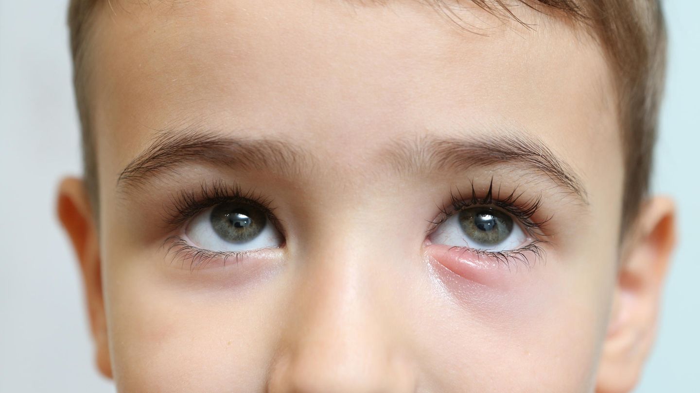 Gerstenkorn bei Kindern: Was dagegen hilft | Eltern.de